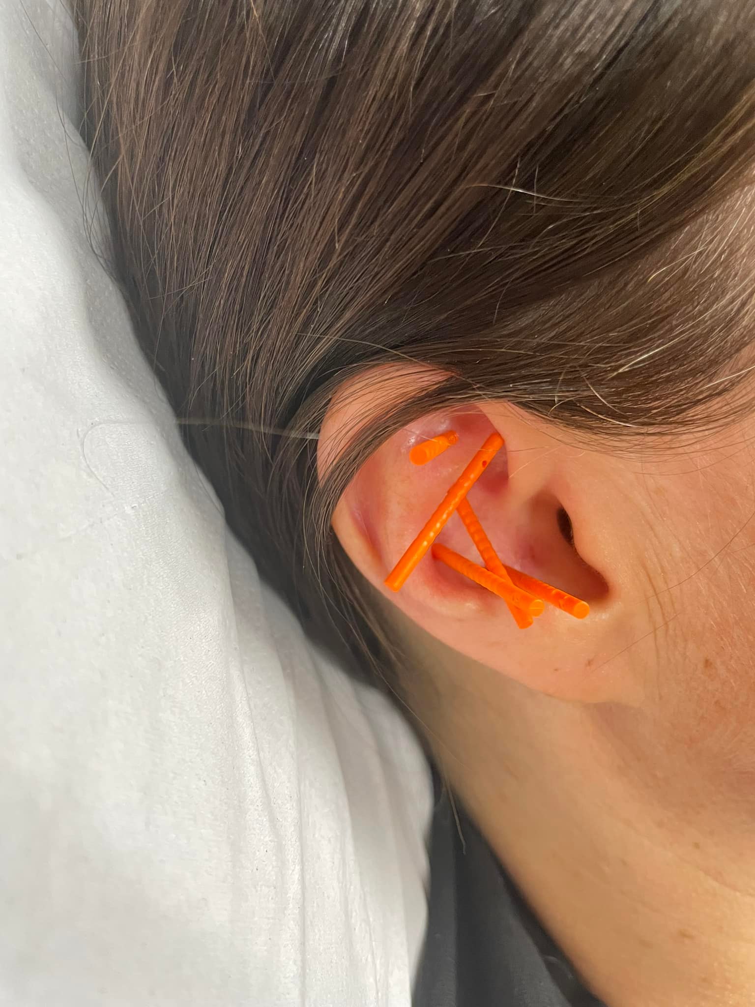 The power of auricular needling: a journey through my practice - BAcC